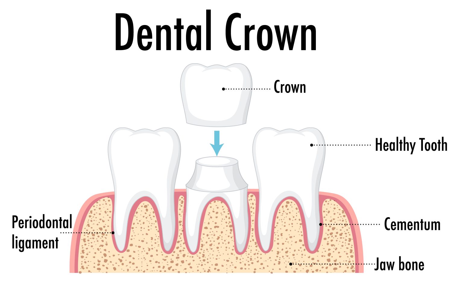 Dental Caps: What You Need to Know